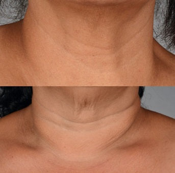 NeckPerfect Complex by iS Clinical UK