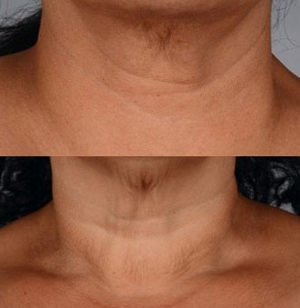 NeckPerfect Complex by iS Clinical UK
