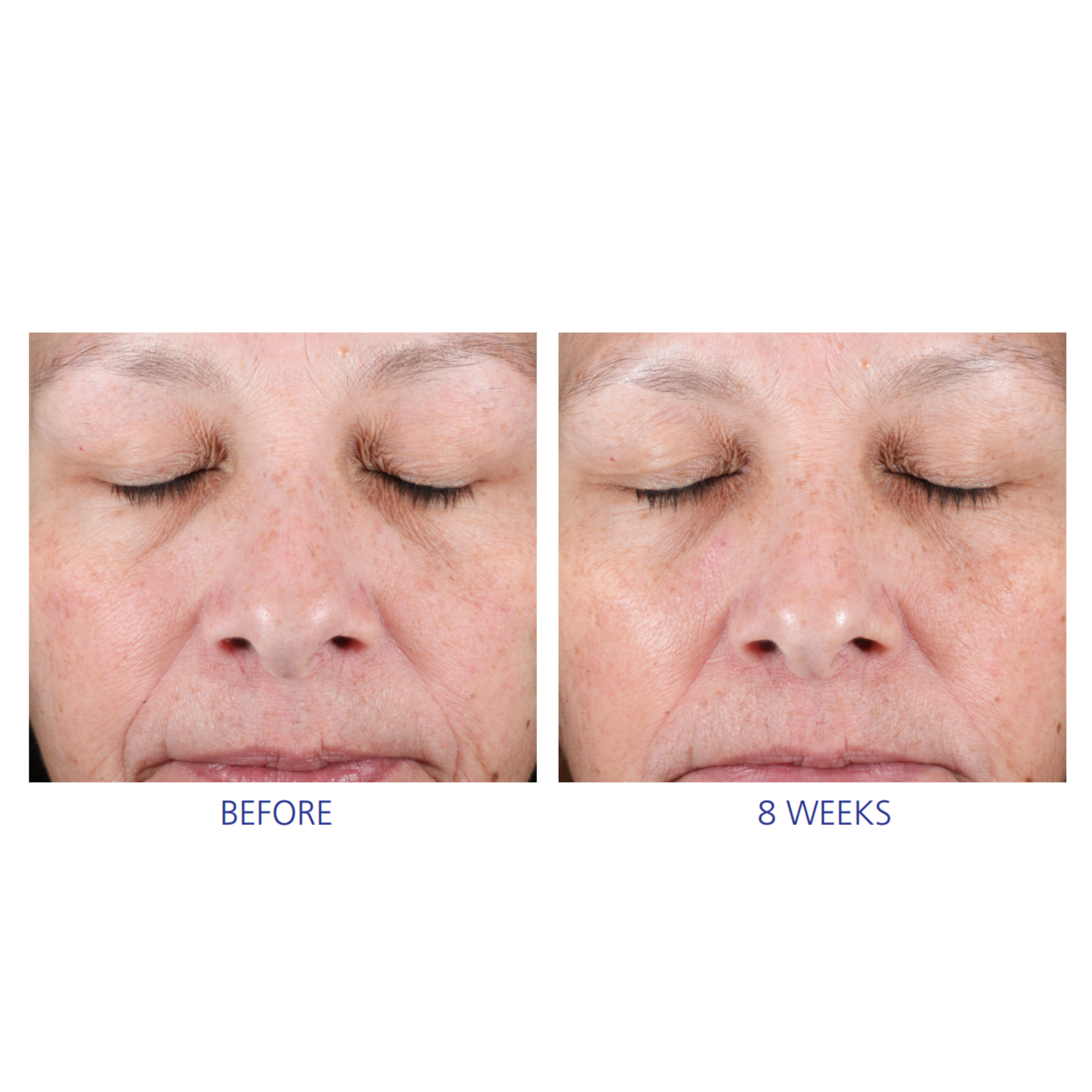 Active Peel System by iS Clinical UK