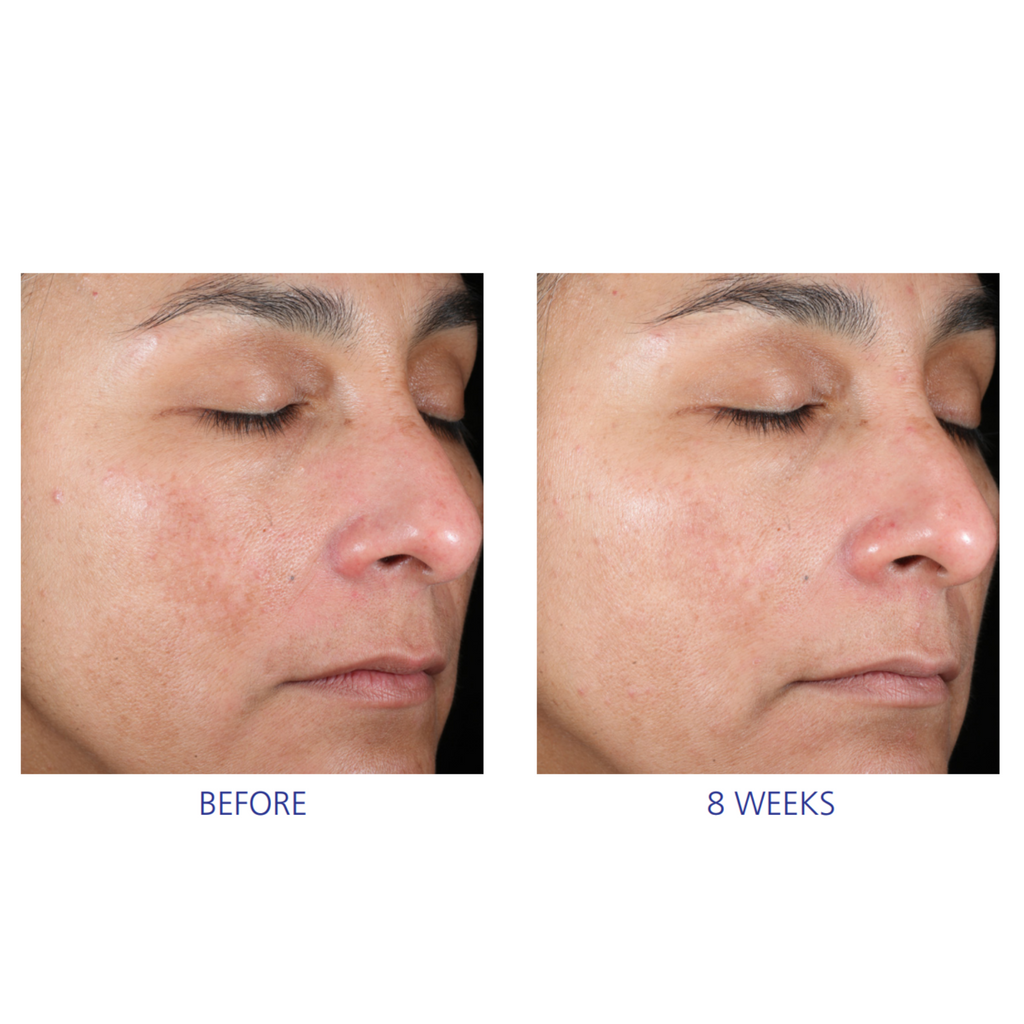 Active Peel System – iS Clinical