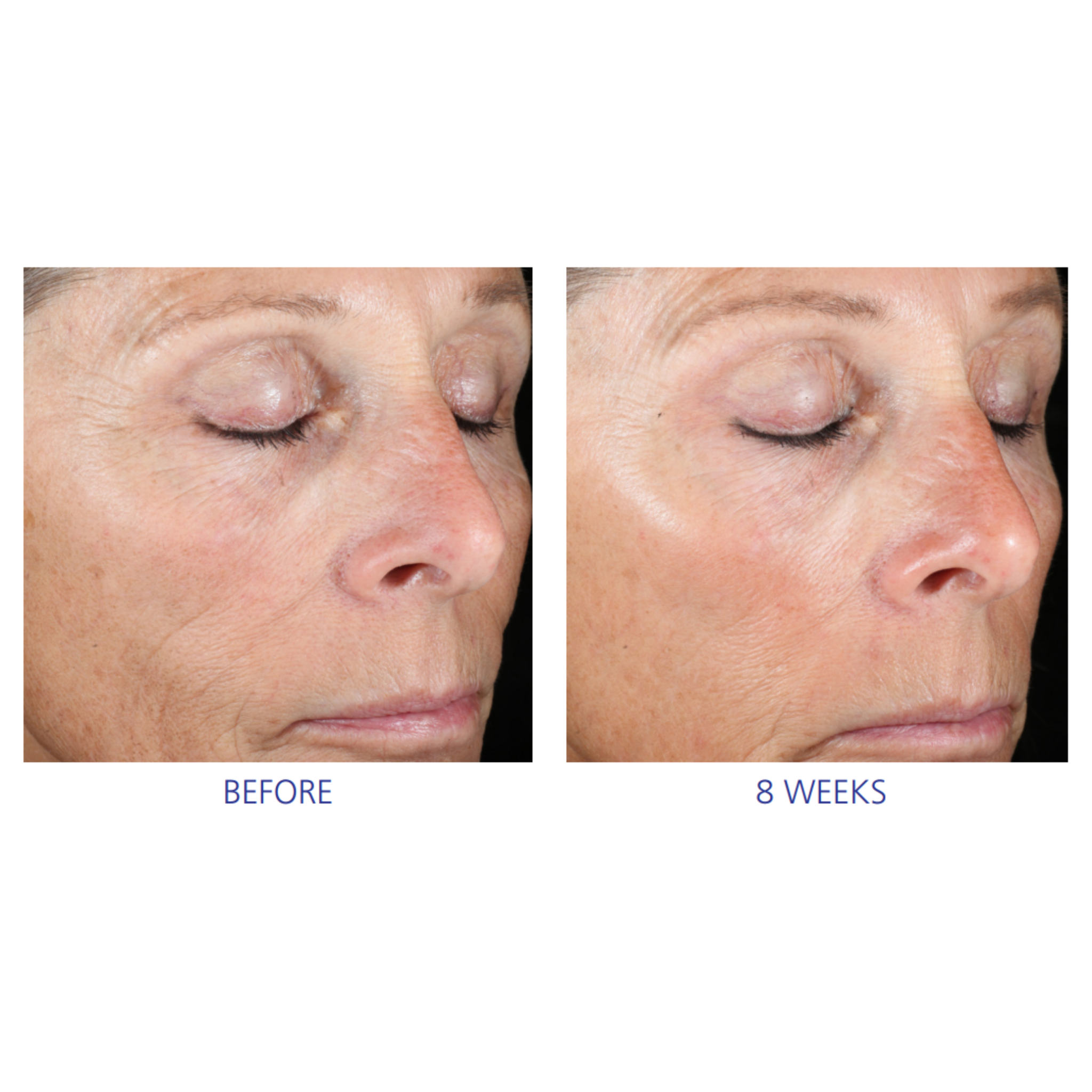 Active Peel System by iS Clinical UK